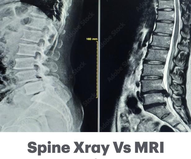 Spine Xray vs MRI - Best Spine Surgeon in Mumbai | Top Spine surgeon in ...